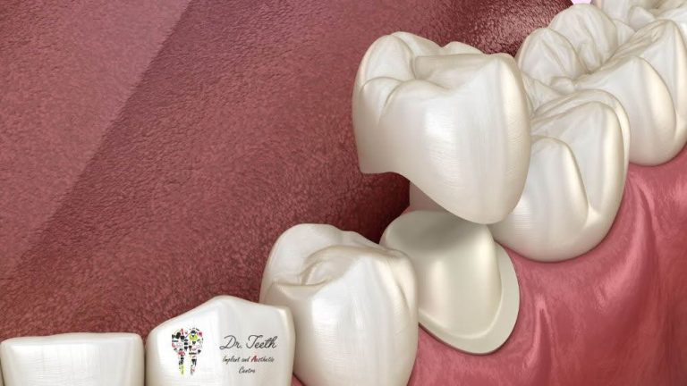 Dental Crown vs Root Canal: Differences & Benefits