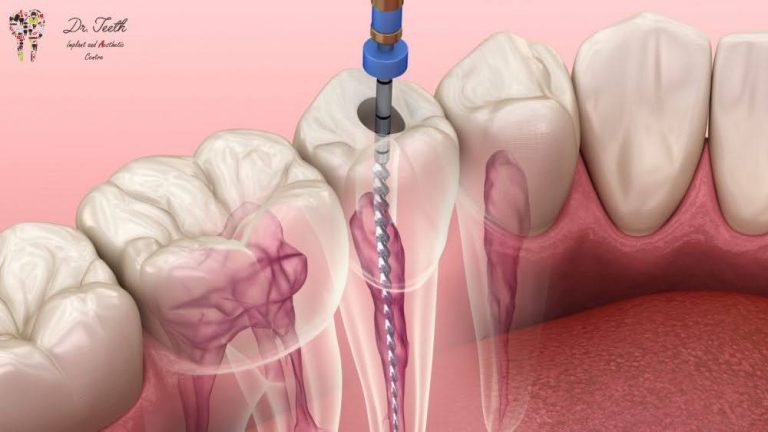 Dental Crown vs Root Canal: Differences & Benefits